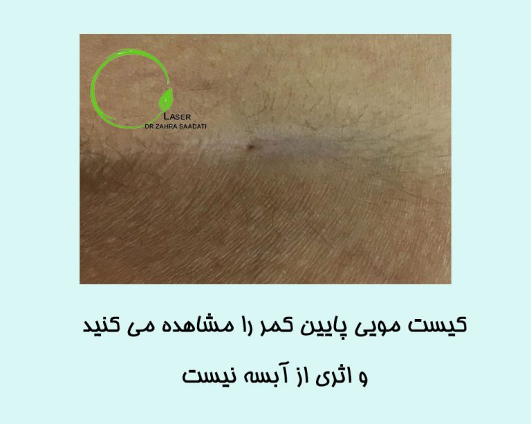 تفاوت کیست مویی با آبسه دکتر زهرا سعادتی متخصص جراحی و لیزر