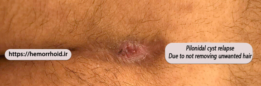 Pilonidal Cyst In The Lower Back - Dr. Zahra Saadati Laser Surgery