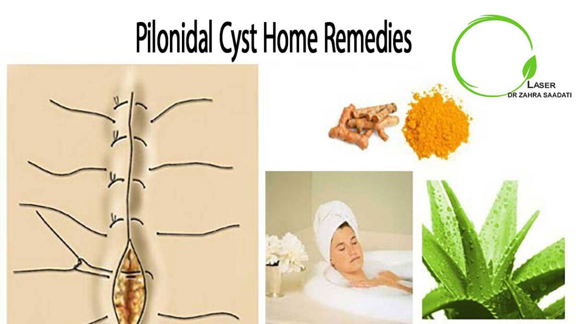 Home Remedies for Pilonidal Sinus - Dr. Zahra Saadati Laser Surgery